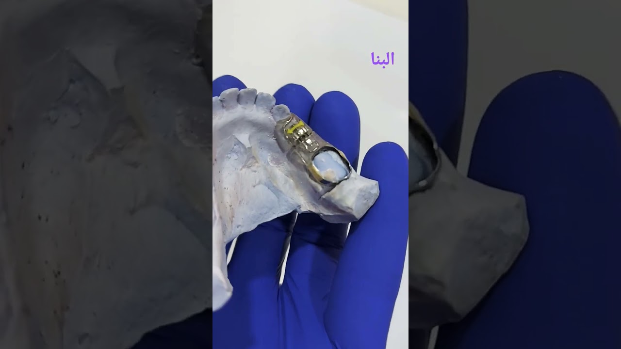 combination of space maintainer and space regainer