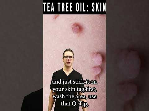 Skin Tag Removal & Wart Removal [Tea Tree Oil Natural Remedy]