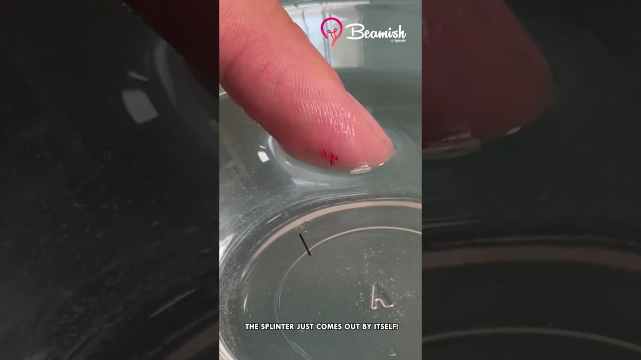 Easy Splinter Removal Trick #easy #removal #tricks