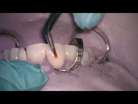 Using a Zeiss Extaro 300 Electronic Dental Microscope at Soho Dental
