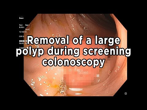 Removal of a large polyp found during a screening colonoscopy. THESE HAVE NO SYMPTOMS!