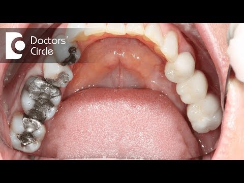What is a Composite Resin White Filling? -Dr. Abhishek Bhadranna