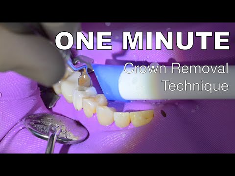 One Minute Crown Removal for Dentists