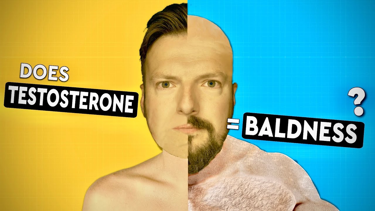 New Study 2025: Does Testosterone Cause Hair Loss