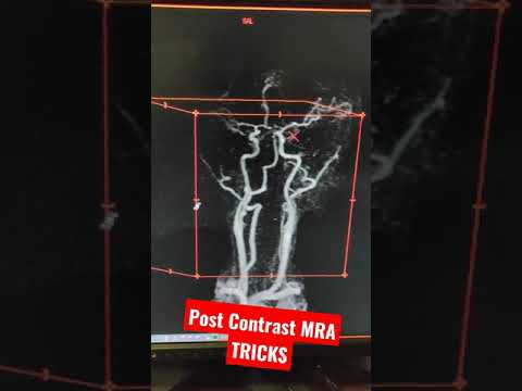 Post Contrast MRI Brain - Neck Angiography (TRICKS) GE 1.5 Tesla #shorts #shortsvideo #youtubeshorts