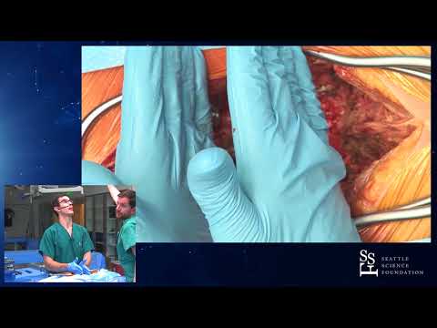 Live Demo: Pedicle Subtraction Osteotomy - Michael P. Kelly, MD