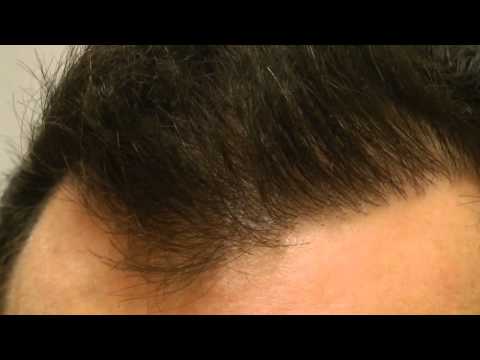 7200 grafts (15,850 hairs) FUT Norwood 5