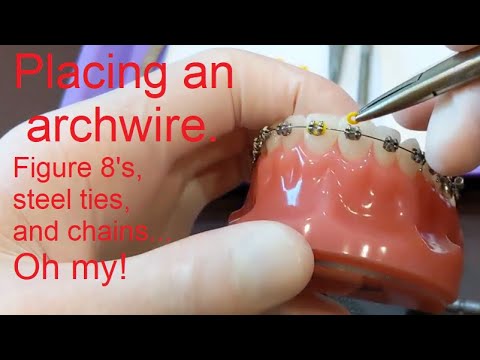 Placing an Archwire