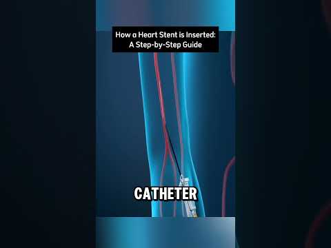 How a Heart Stent is Inserted: A Step-by-Step Guide