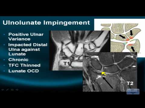 MRI Online: Wrist Part VI Evaluating Impingement Syndromes of the Wrist