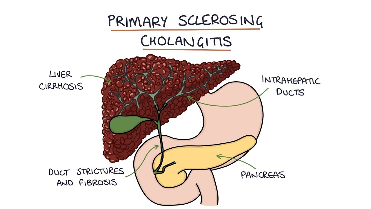 Primary Sclerosing Cholangitis: Visual Explanation for Students