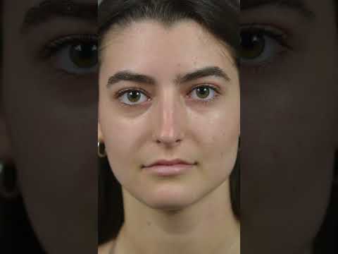 Stunning Rhinoplasty Transformation at MarottaMD