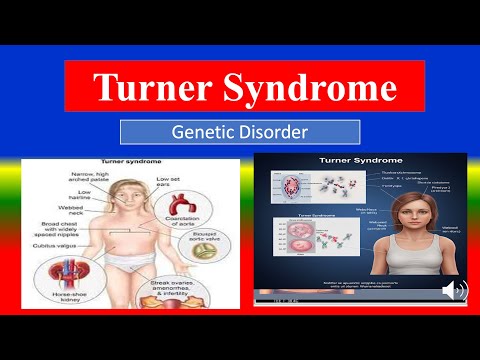TURNER SYNDROME- Definition, types, causes, pathophysiology, symptoms , diagnoses , medicine