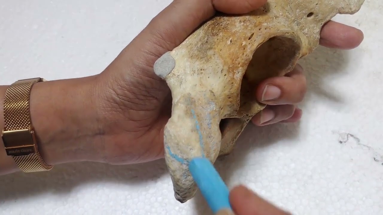 Ischial tuberosity of hip bone