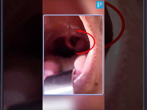 Unilateral Tonsillar Enlargement