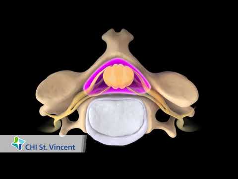 Posterior Cervical Laminectomy and Fusion