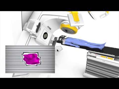 Stereotactic Radiosurgery – A minimally invasive form of surgery ...