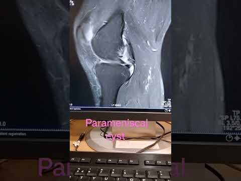 MRI lt.knee pd fs sq