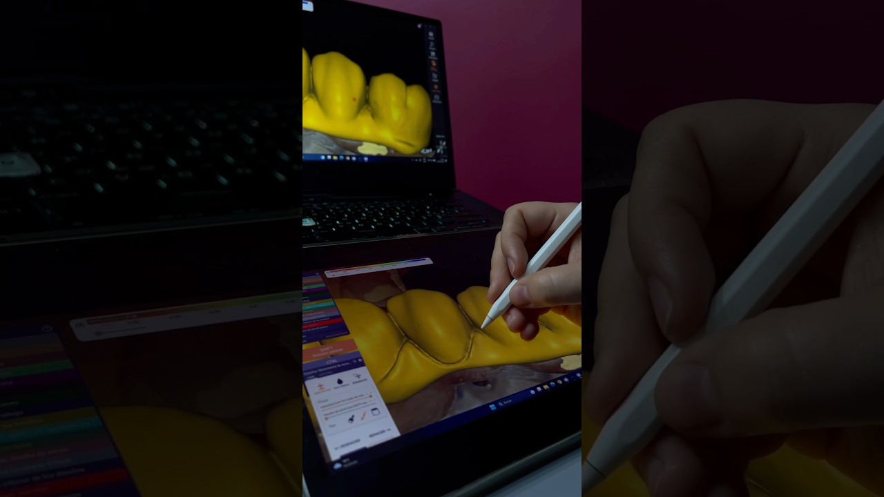 Exocad en iPad