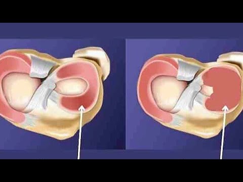 The Discoid Meniscus