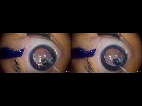 3D Surgery: Pediatric Nuclear Cataract with Posterior Element: Dr. Asim Ali