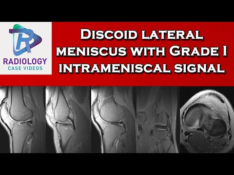 Discoid lateral meniscus with Grade I intrameniscal signal