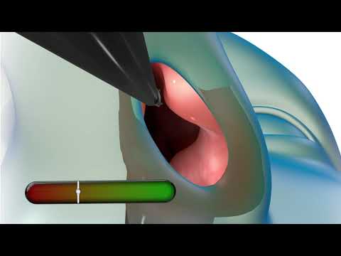 Reshaping Nasal Airflow For Better Breathing With VivAe