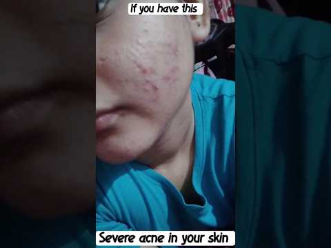 clindamycin Benzoyl peroxide Gel l for acne #trending #viral #youtubeshorts #shorts #acne #skincare