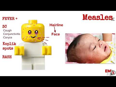 Measles
