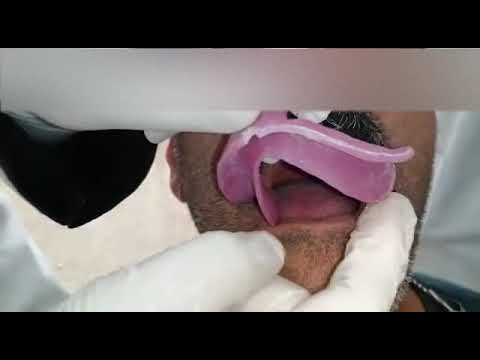 Visit 2: Difference beteween the lingual flange and the buccal flange of the lower tray