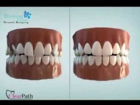 ClearPath Aligners | Winning Smiles Dental Surgery