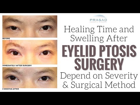 Factors that Affect Healing Time and Temporary Swelling of Eyelid Ptosis Surgery