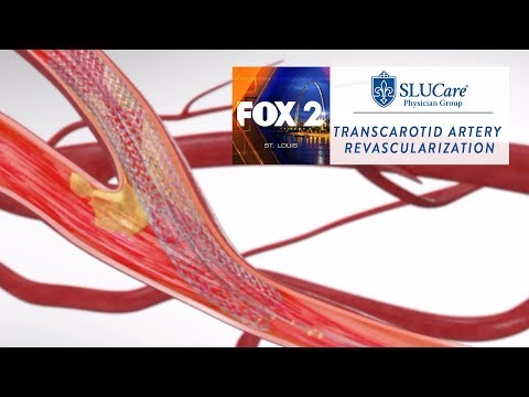 New TCAR Procedure Removes Blockages in Carotid Artery - SLUCare Health Watch