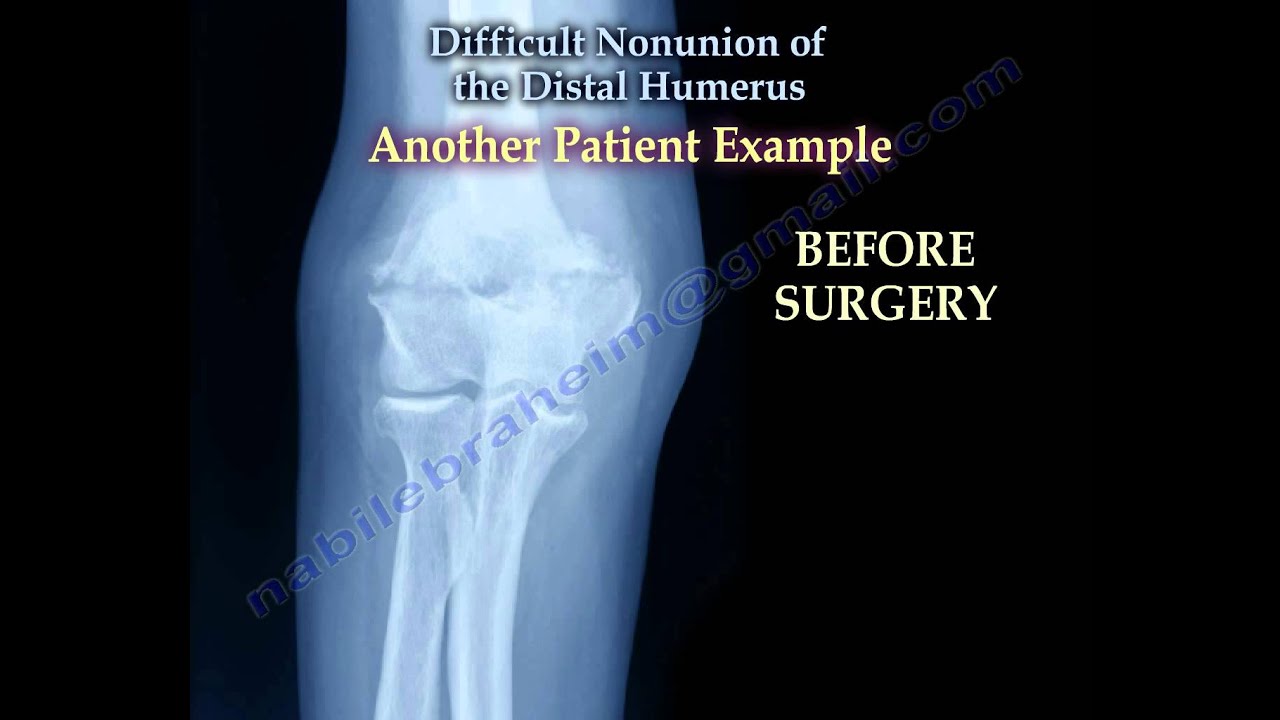 Difficult Nonunion Of The Distal Humerus - Everything You Need To Know - Dr. Nabil Ebraheim
