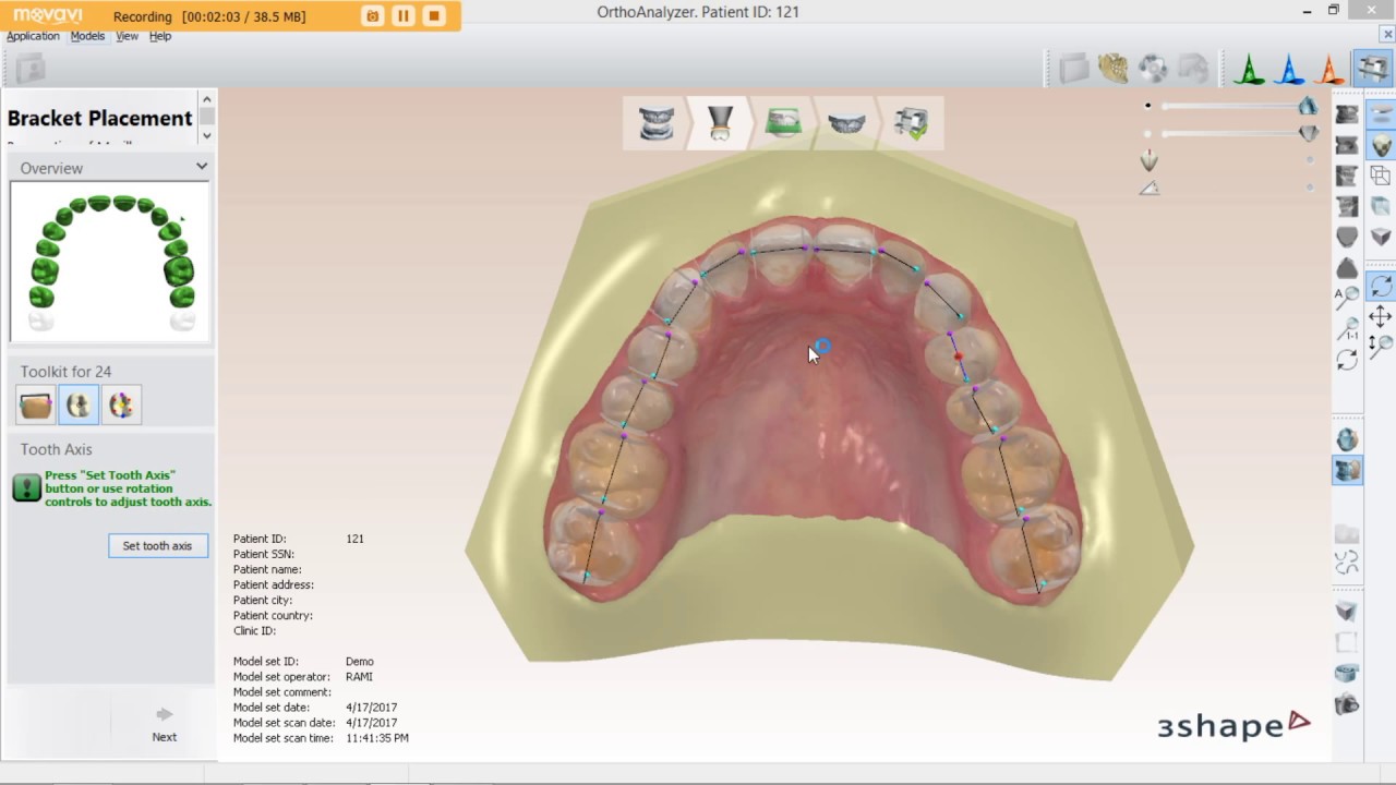 How to Do a Model Segmentation for Brackets Placement in 3Shape