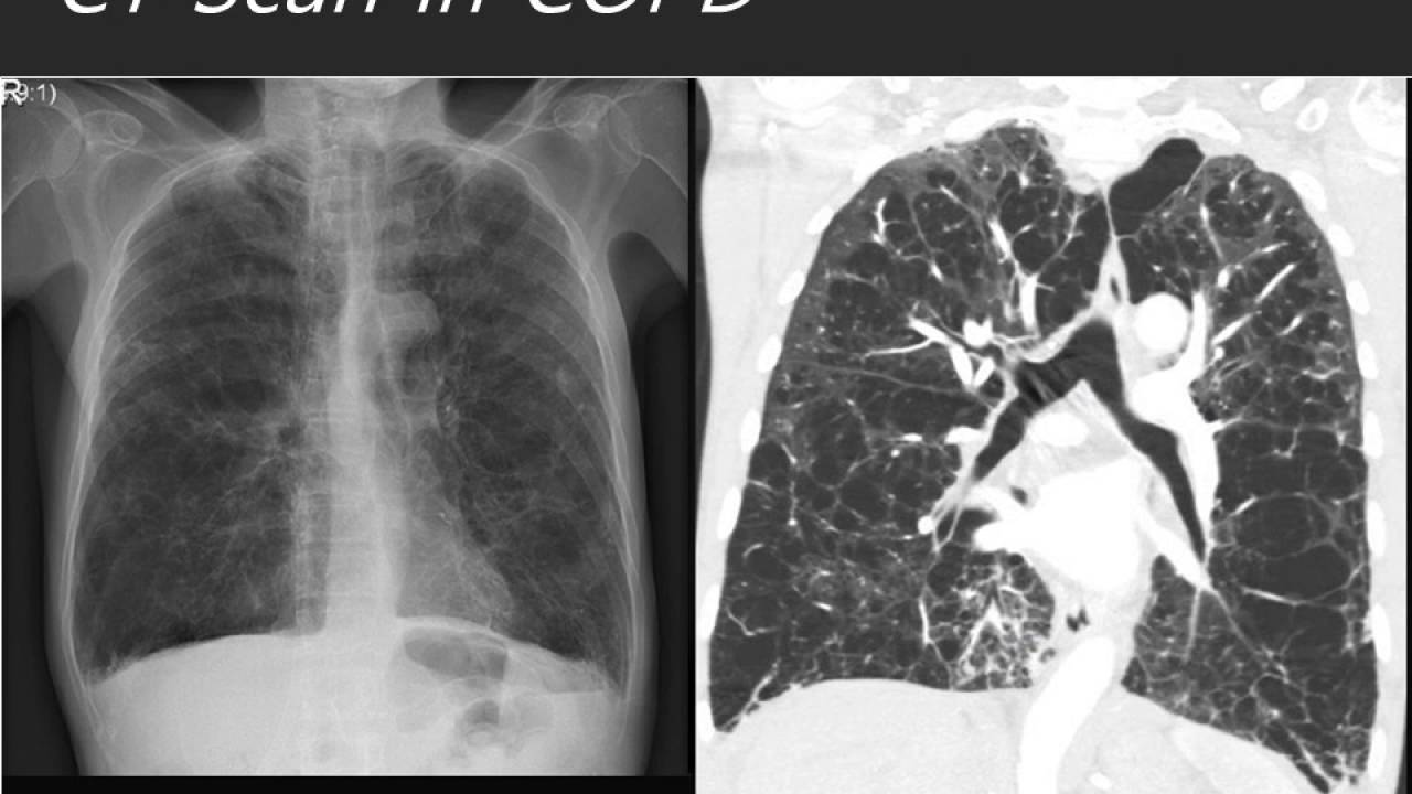 APPROACH TO COPD  937