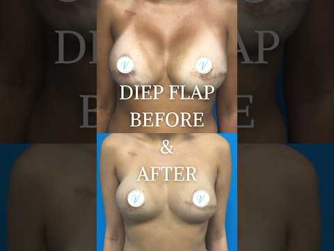 DIEP flap #beforeandafter #breastcancer #plasticsurgeon