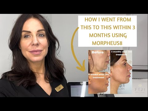 Is Morpheus8 worth it? Before & After of Morpheus8, Radiofrequency & Microneedling Review