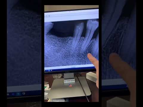 A few root canals. That’s all!
