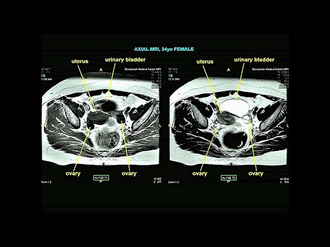 Radiology of the Pelvis (with optional subtitles)