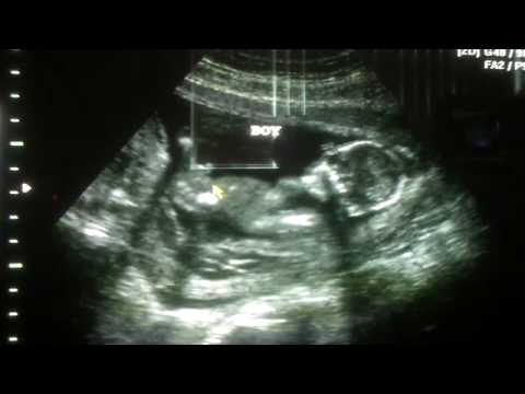 Update on 14 week gender scan! — The Bump