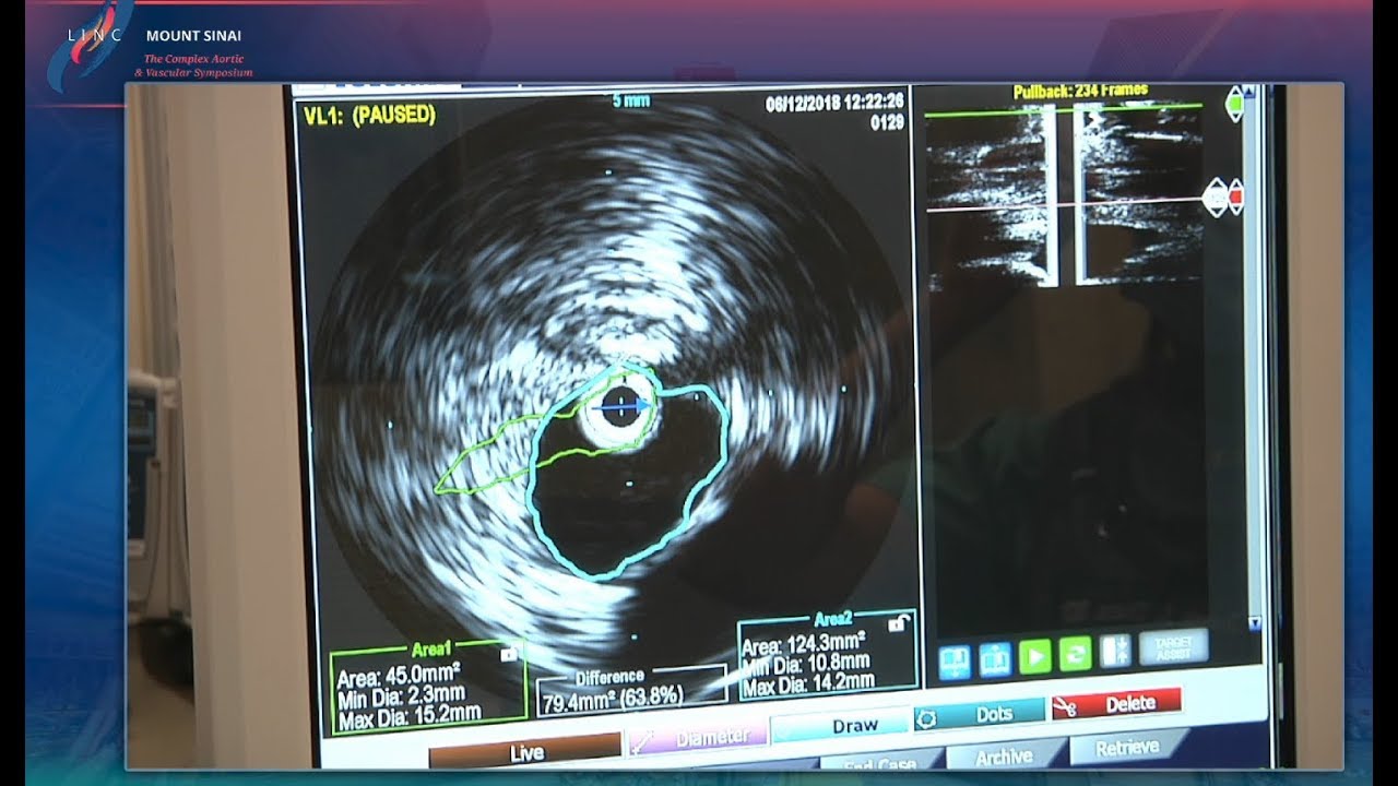 Venogram, IVUS, Venoplasty/Stenting - LINC 2018 LC 6 Sinai_Ting - Tue 2:08pm