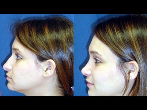 Rhinoplasty Consult in Baltimore- A Guide to Medical Terms for Nose Surgery