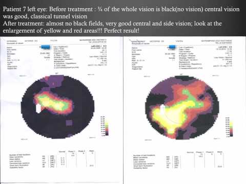 Proof (Visual Field Test Results) - Retinitis Pigmentosa Treatment With ...