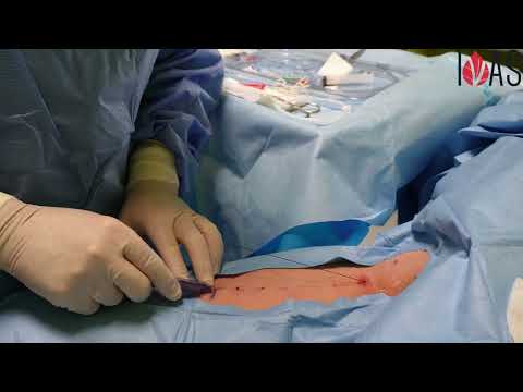 Thigh Picc with Tip Navigation - Picc femorale con Tip Navigation