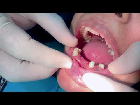 Before & After Smile Makeover Transformations | Dr. Shafeer | Best Dentist in Sharjah