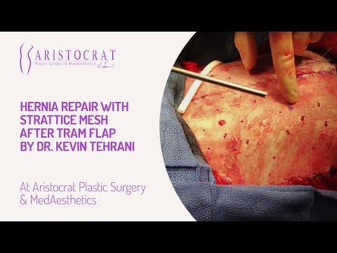 Hernia Repair with Strattice Mesh After TRAM Flap by Dr. Kevin Tehrani