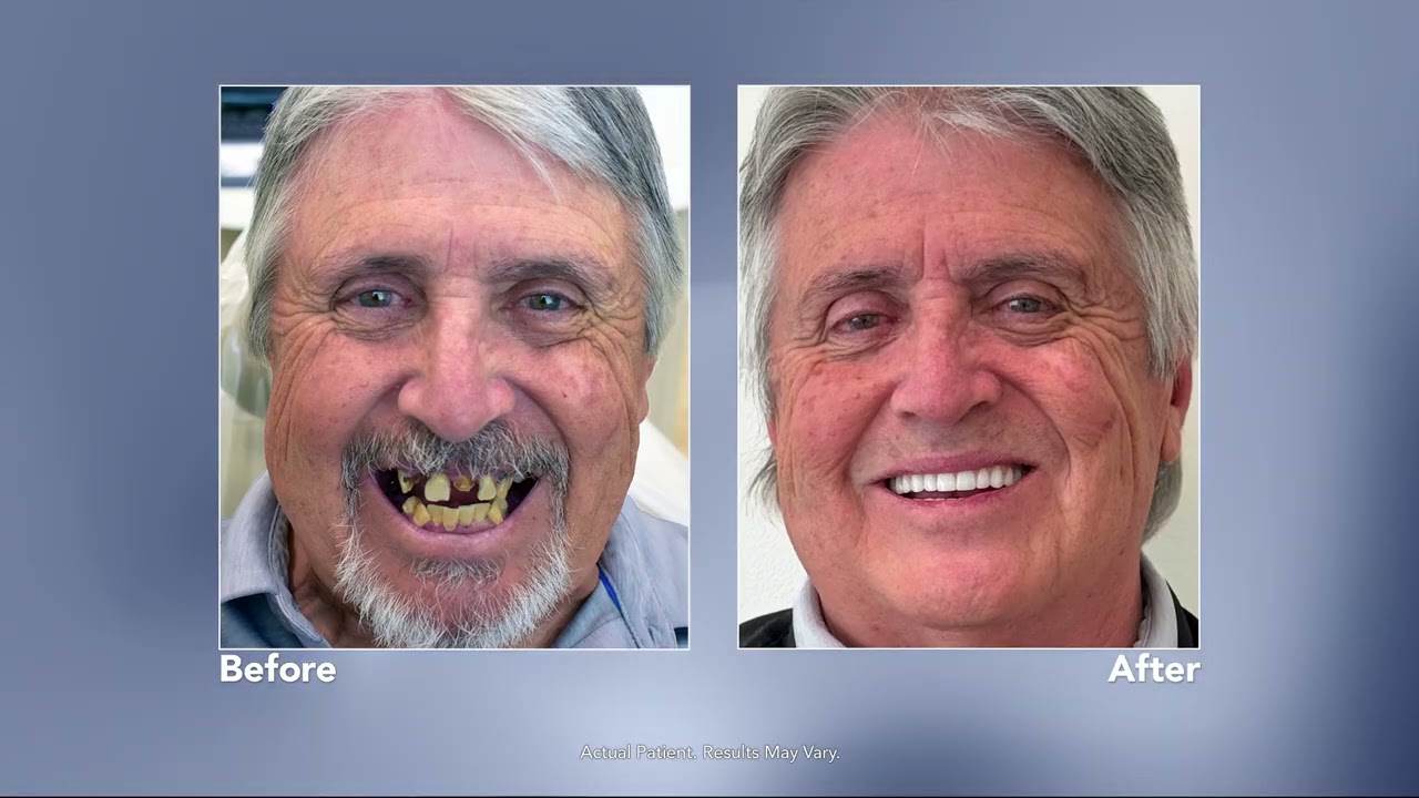 Extreme Smile Makeovers | Jordan Swarbrick, DDS – Draper, UT dentist