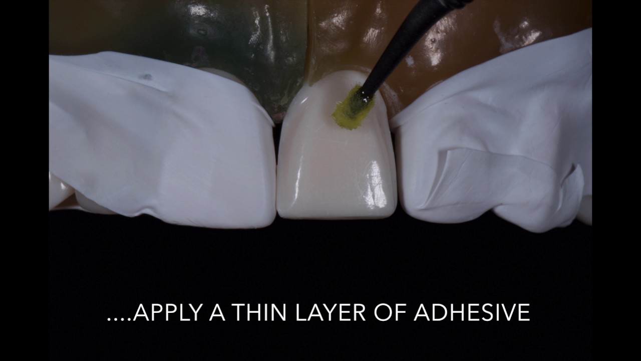 Porcelain Veneer Cementation step by step technique
