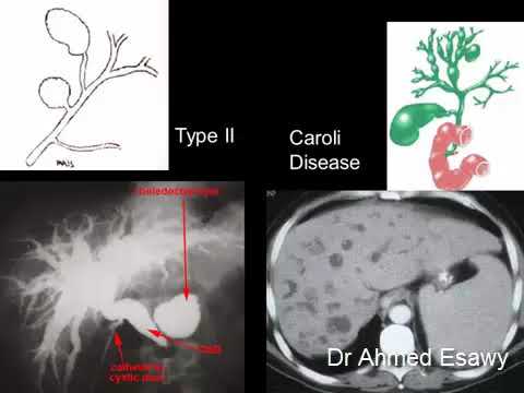 14 CASE REVIEW CT MRI hepatic ,biliary ,GB